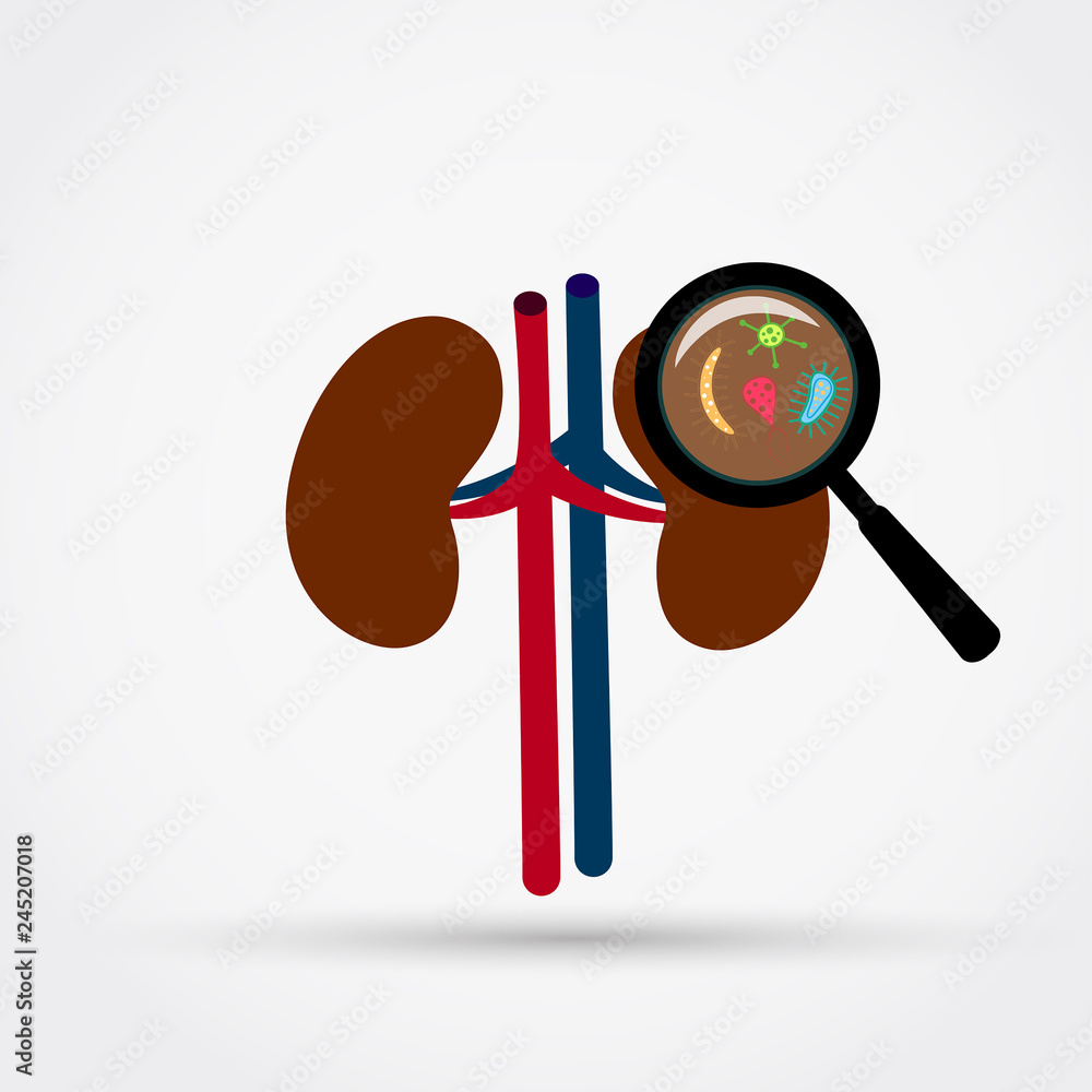 Kidney infection vector illustration. Stock Vector | Adobe Stock