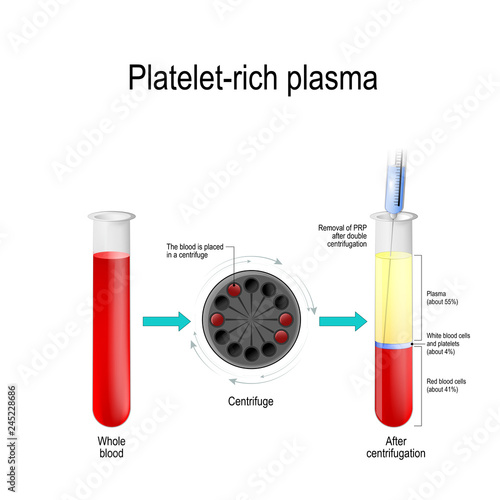 Platelet-rich plasma. - Buy this stock vector and explore similar ...