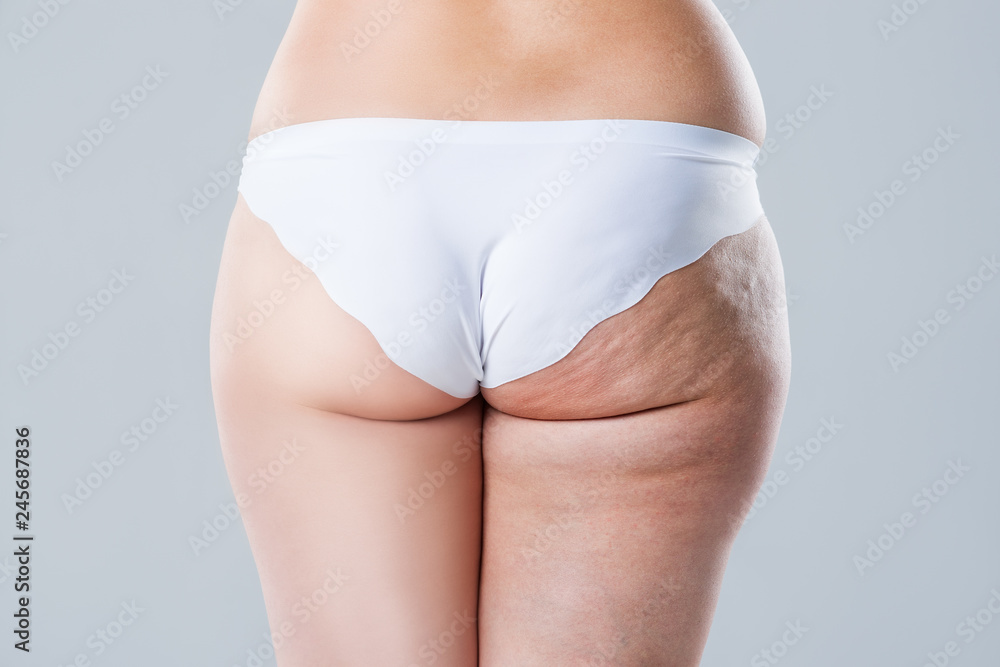 Overweight woman with fat cellulite legs and buttocks, before after concept, obesity female body ...