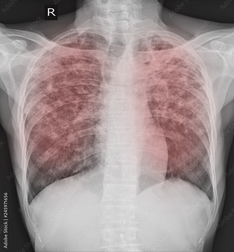 Pulmonary Tuberculosis ( TB ) : Chest x-ray . Stock Photo | Adobe Stock