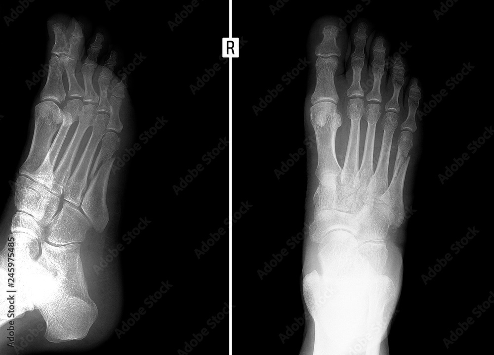 X-ray of the foot. Fracture of the 5th metatarsal bone. Stock Photo ...