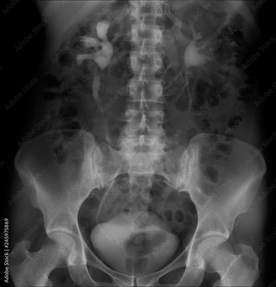 X-ray of the abdomen. Hydronephrosis right. Pyeloectasia left. Stock ...