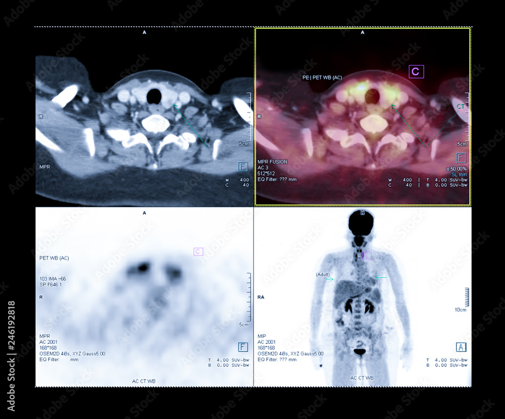 PET Scan image of the neck or thyroid gland Comparison CT scan image vs ...