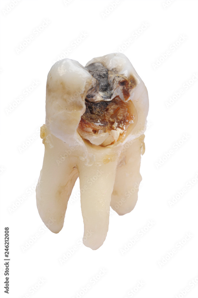 Stock-Foto „Backenzahn mit Karies extrahiert“ | Adobe Stock