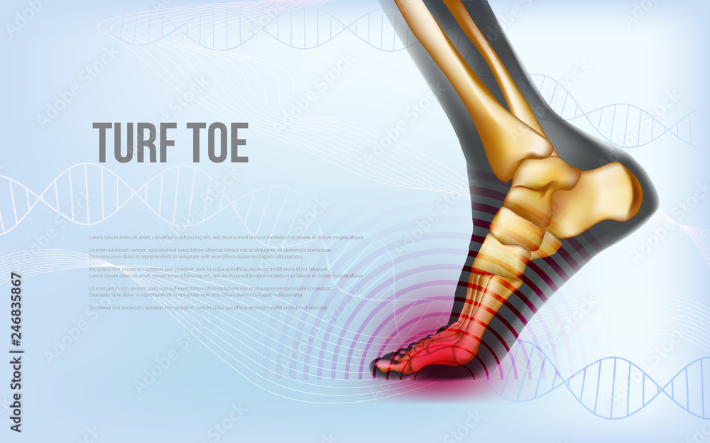 Horizontal turf toe foot traumas banner Stock Vector | Adobe Stock