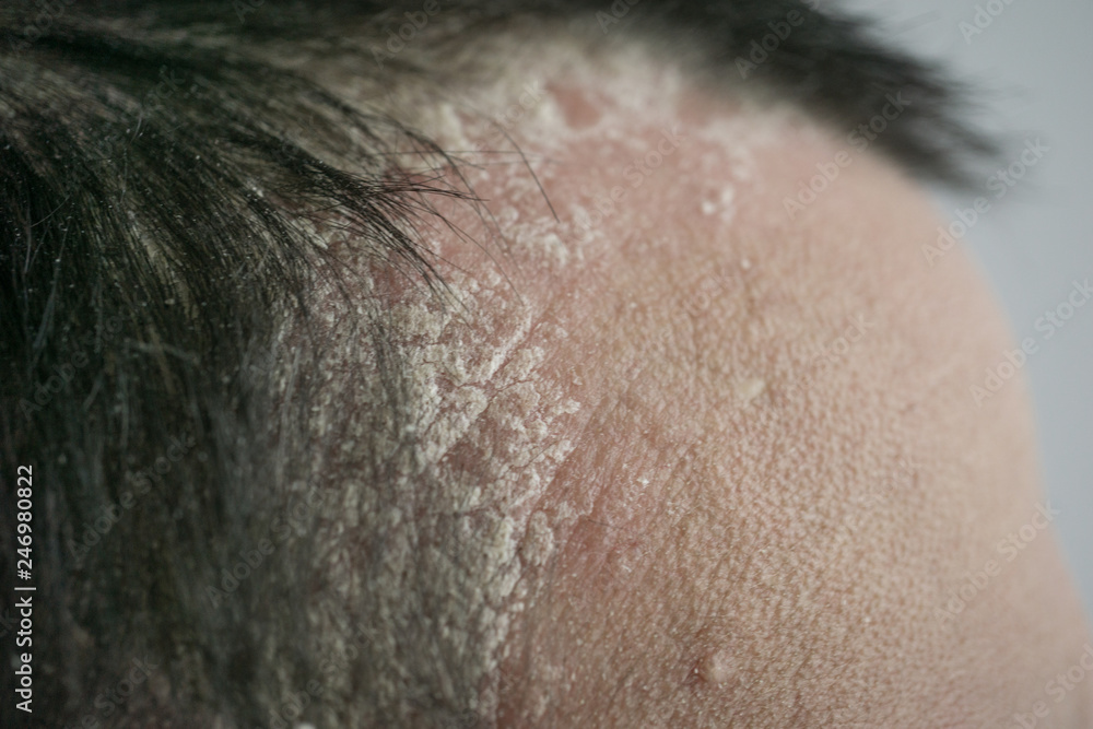 psoriasis on the hairline and on the scalp-close up, dermatological ...
