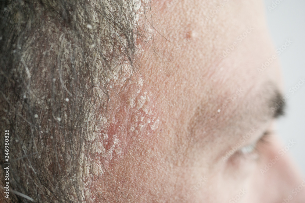 psoriasis on the hairline and on the scalp-close up, dermatological ...