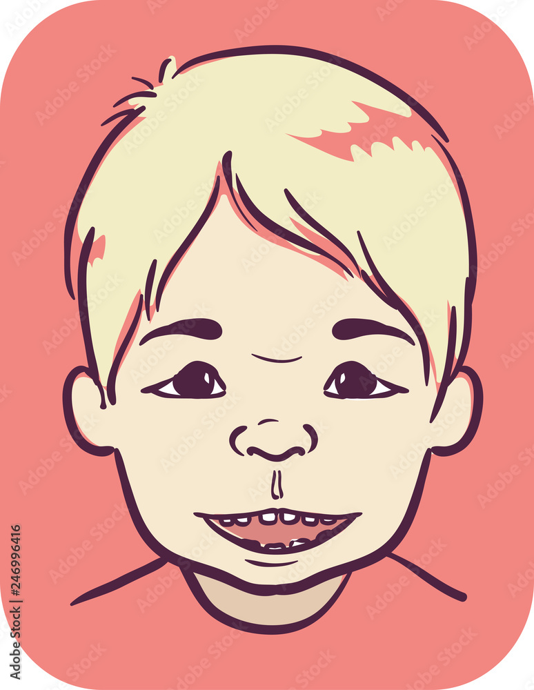 Kid Boy Symptom Angelmans Syndrome Face Stock Vector | Adobe Stock