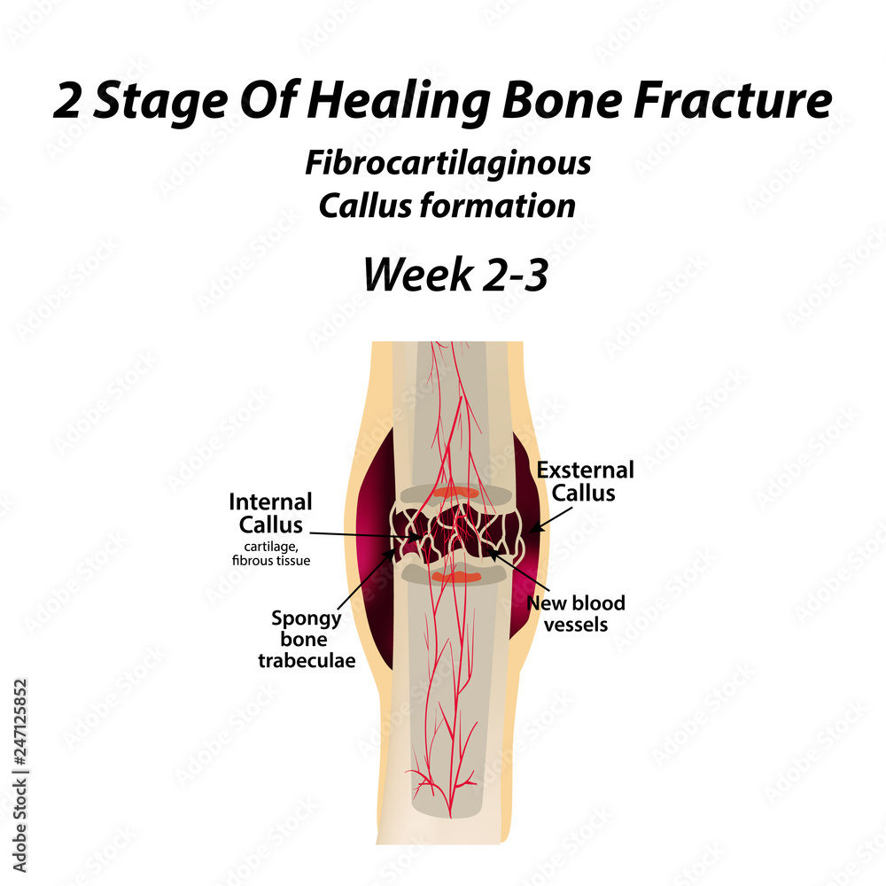 2 Stage Of Healing Bone Fracture. Formation of callus. The bone fracture. Infographics. Vector ...