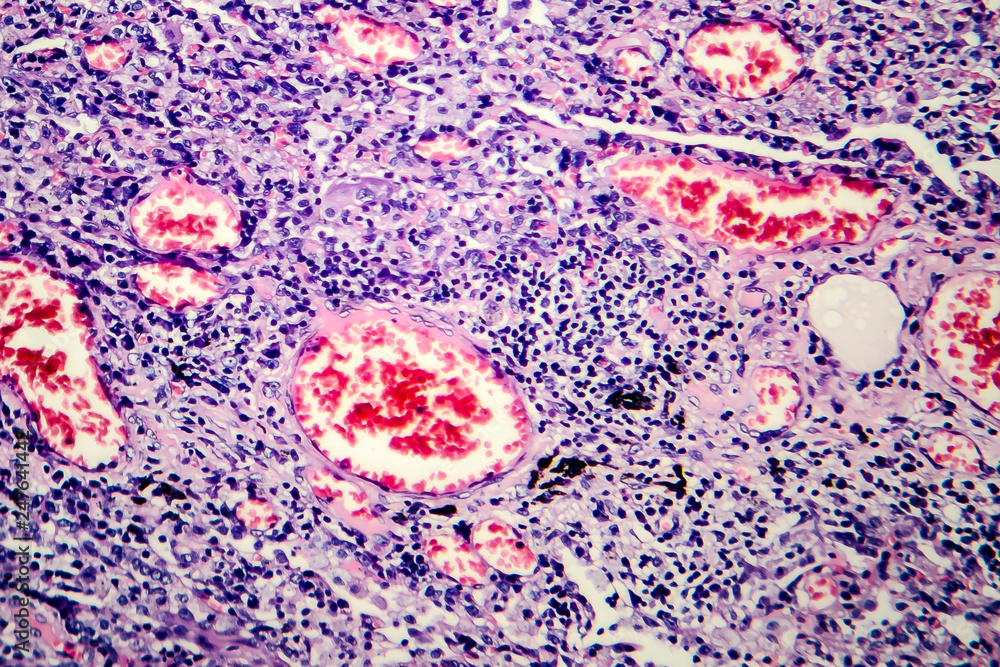 Histopathology of tuberculosis, light micrograph of tuberculosis lesion ...