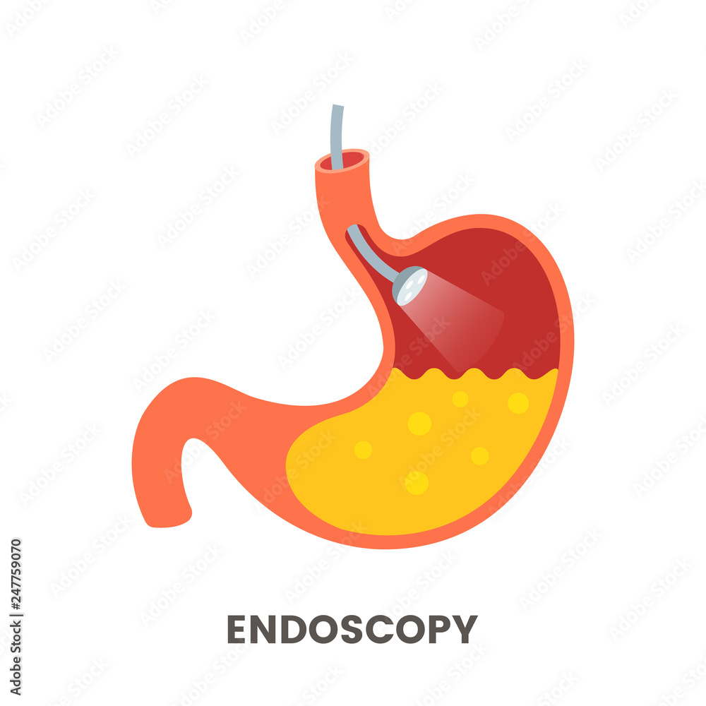 Stomach endoscopy is a flat cartoon endoscope in the stomach through ...