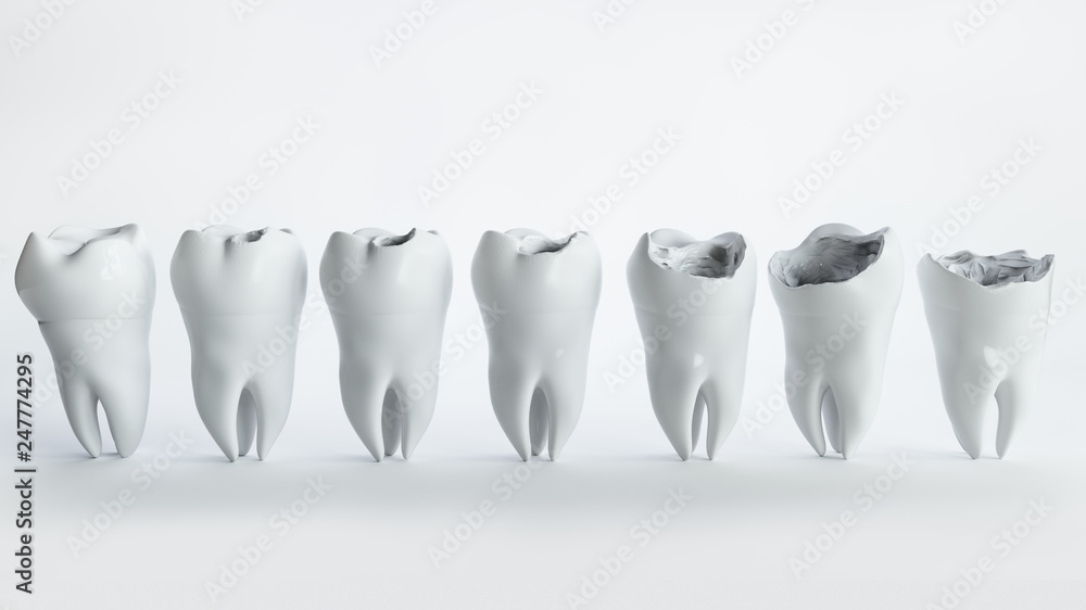 The stages of caries on the molar - 3D Rendering Stock Illustration ...