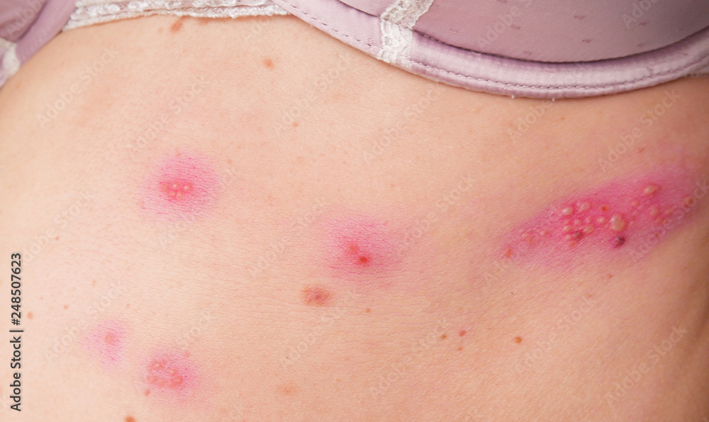 skin rash treatment on woman body. Shingles, Disease, Herpes zoster ...