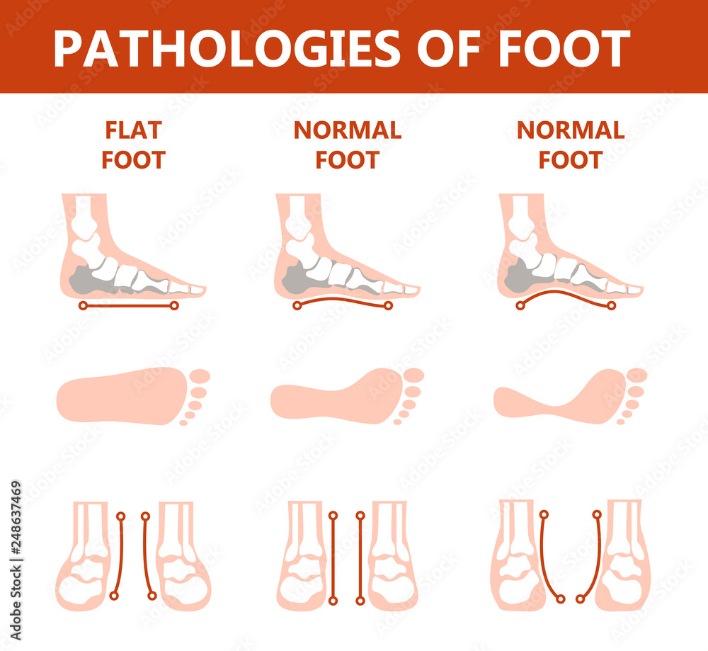Foot pathologies infographic. Flat foot anatomy. Deformed Stock Vector ...