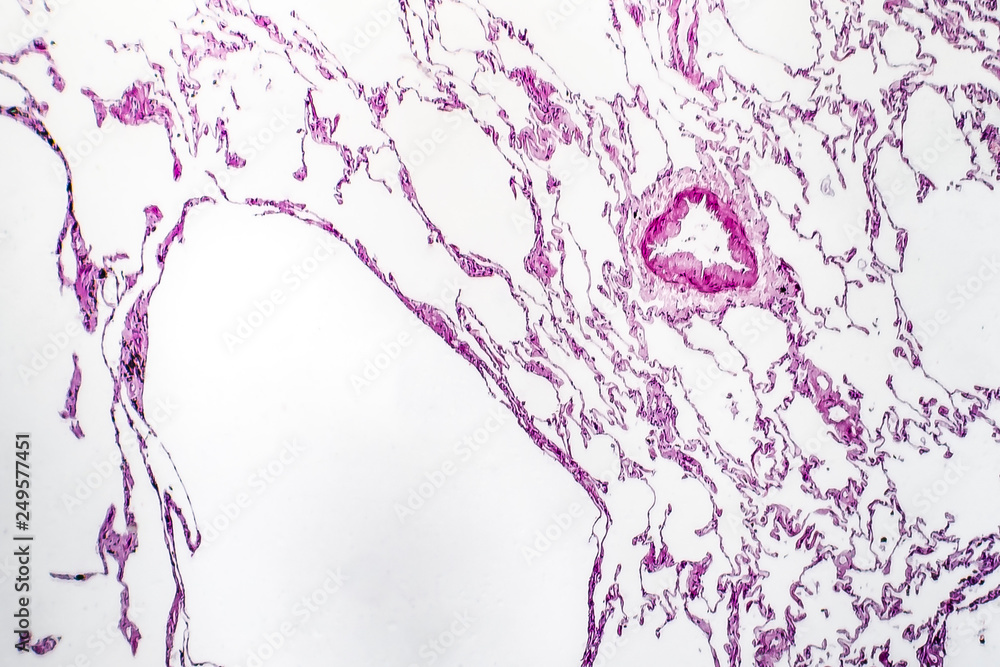 Foto de Stock Histopathology of lung emphysema, light micrograph, photo ...