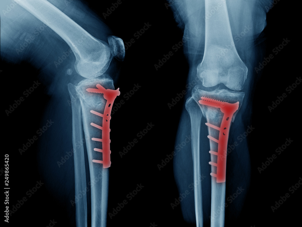 fracture proximal tibia with internal fixation AP and lateral view ...