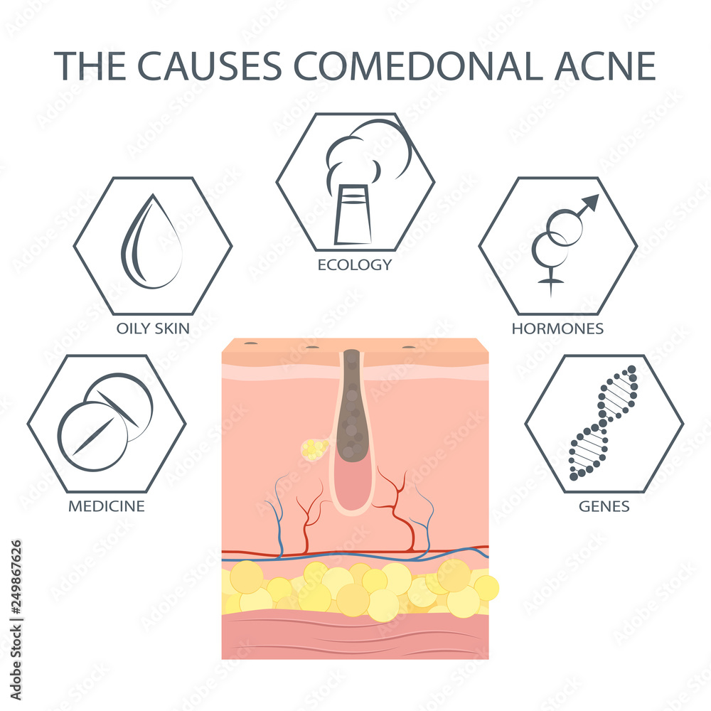 Causes of acne. Dermatology, skin problems, comedonal acne. Causes of black acne on the face ...