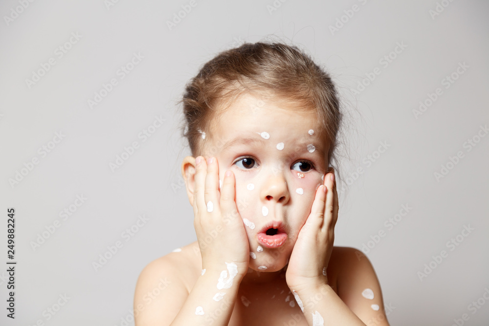 Closeup surprized cute little girl with varicella virus or chickenpox ...
