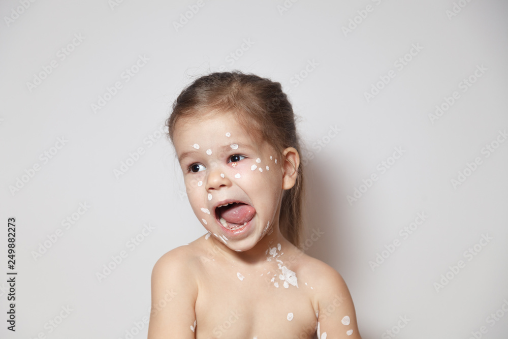 Foto de Stock Closeup face cute little girl with varicella virus or ...