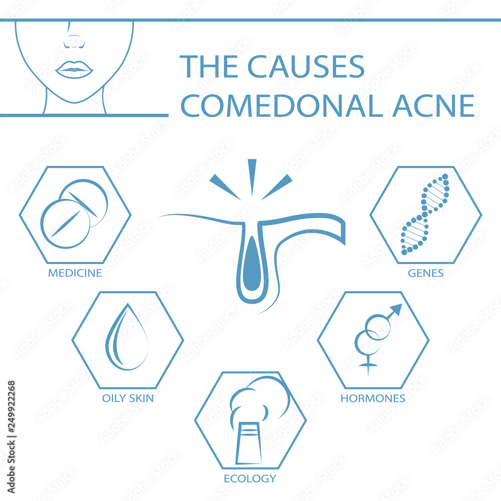 Causes of acne. Dermatology, skin problems, comedonal acne. Causes of ...
