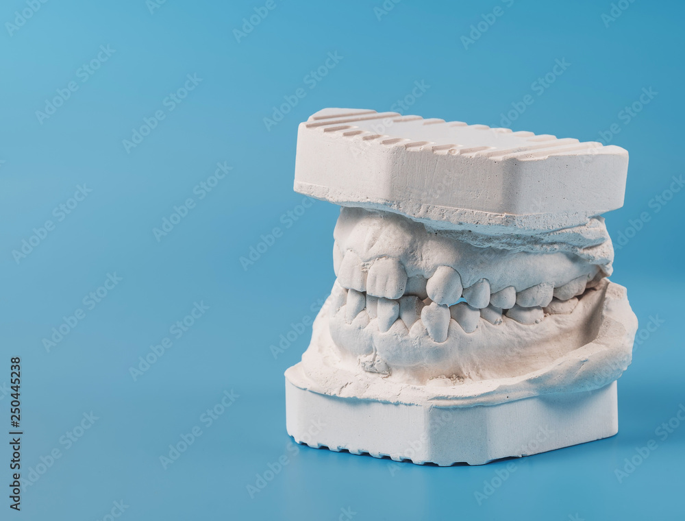 Dental casting gypsum model of human jaws. Crooked teeth and distal ...