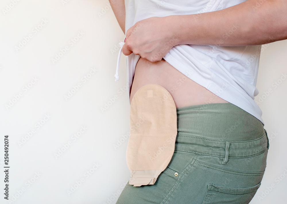 Front view on colostomy pouch in skin color attached to woman patient ...