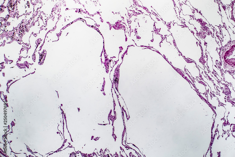 Histopathology of lung emphysema, light micrograph, photo under ...