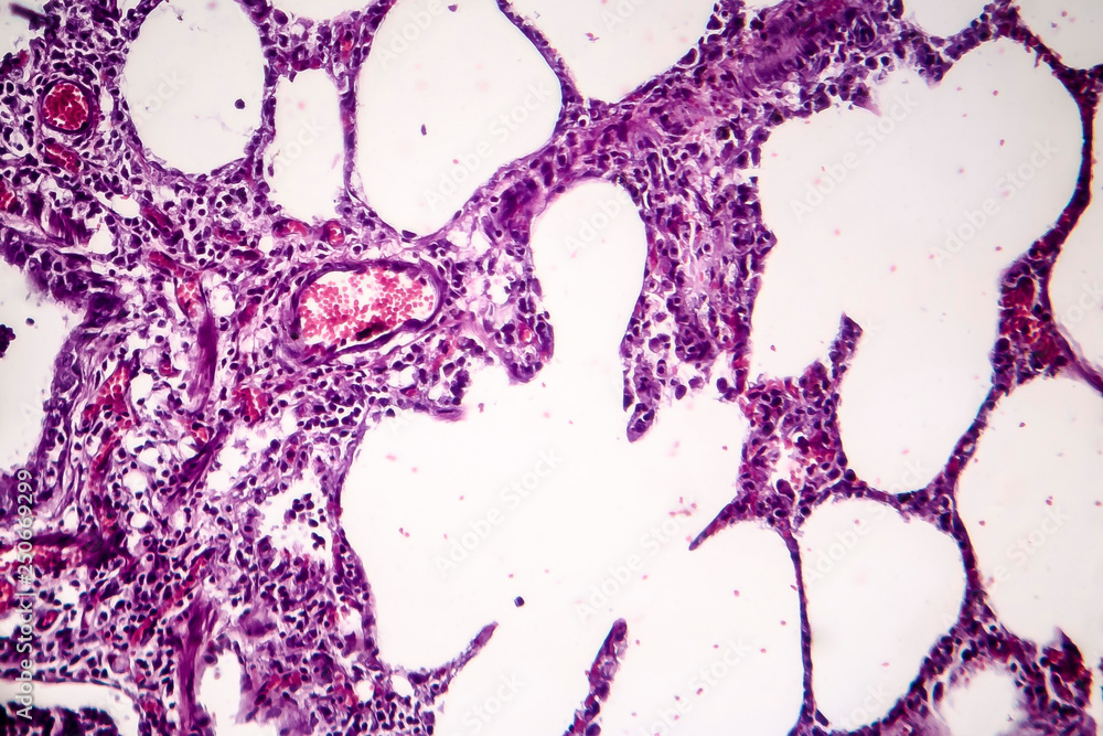 Histopathology of pneumonia, light micrograph, photo under microscope ...