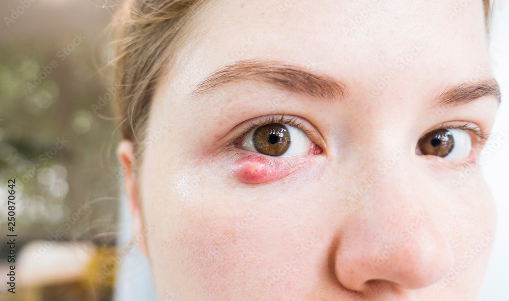 Eyelid abscess. Close up photo of young caucasian woman barley brown ...