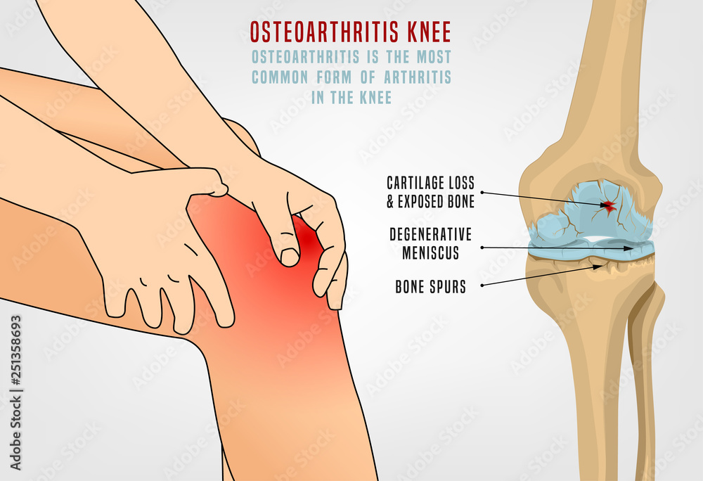 Osteoarthritis Knee Poster Stock Vector | Adobe Stock