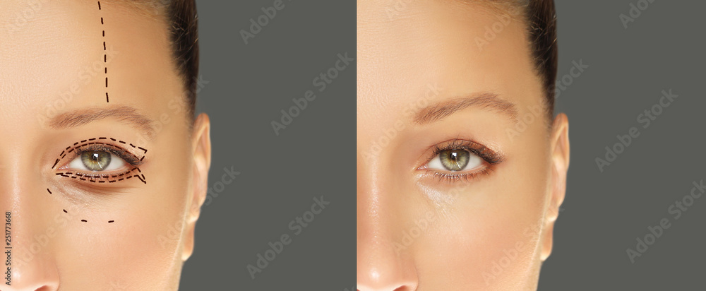 Lower and upper Blepharoplasty.Marking the face.Perforation lines on ...