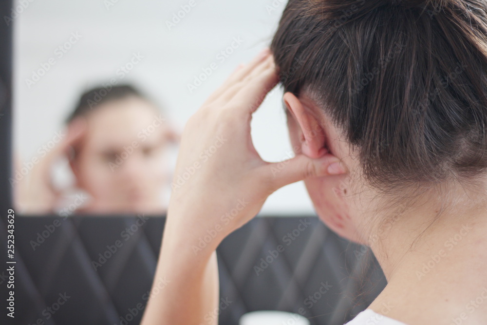 Acne on the face of young women. Improper therapy has led to a severe ...