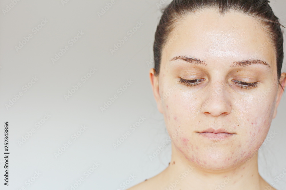 Acne on the face of young women. Improper therapy has led to a severe form of chronic ...