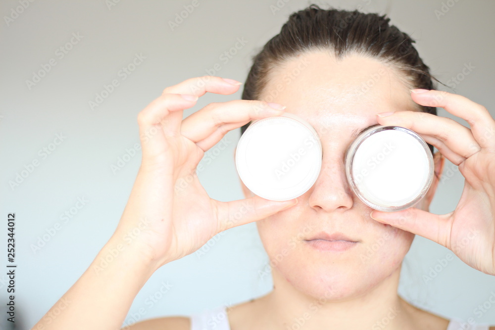 Acne on the face of young women. Improper therapy has led to a severe ...