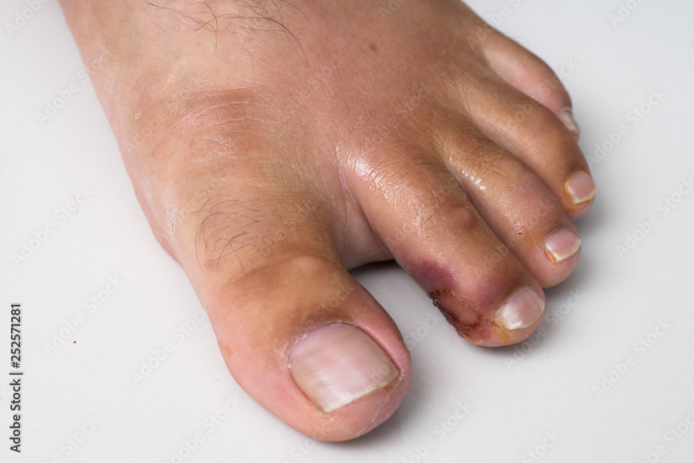 Finger on the leg. Purulent wound on the leg. Eczema. Dermatitis ...