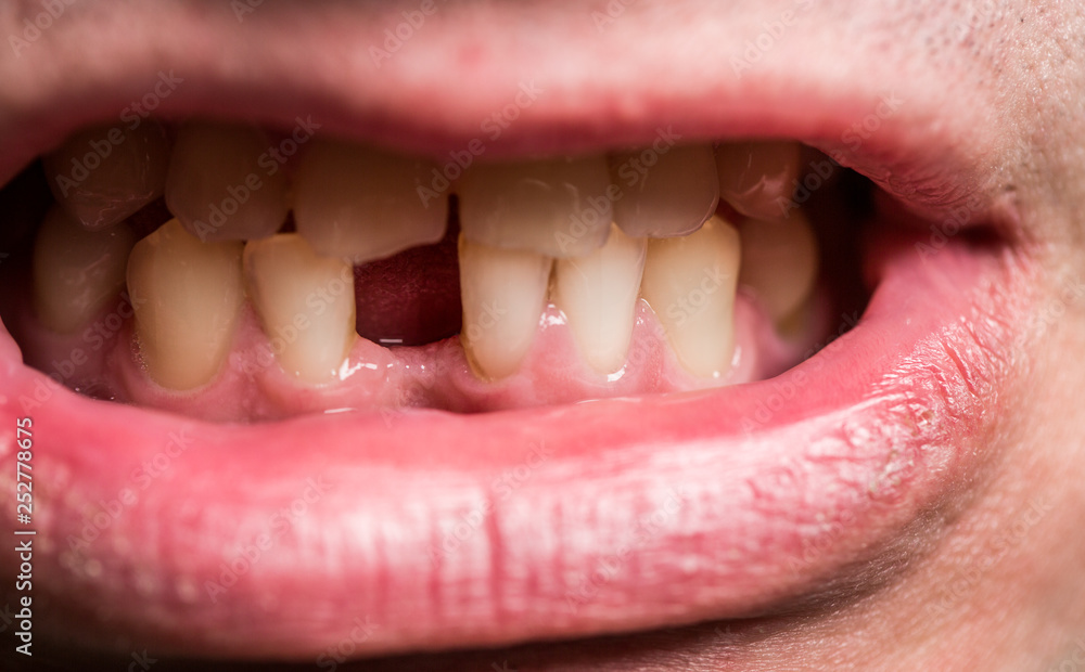 Foto de Stock Man without one front tooth. Bad dental health, no teeth ...