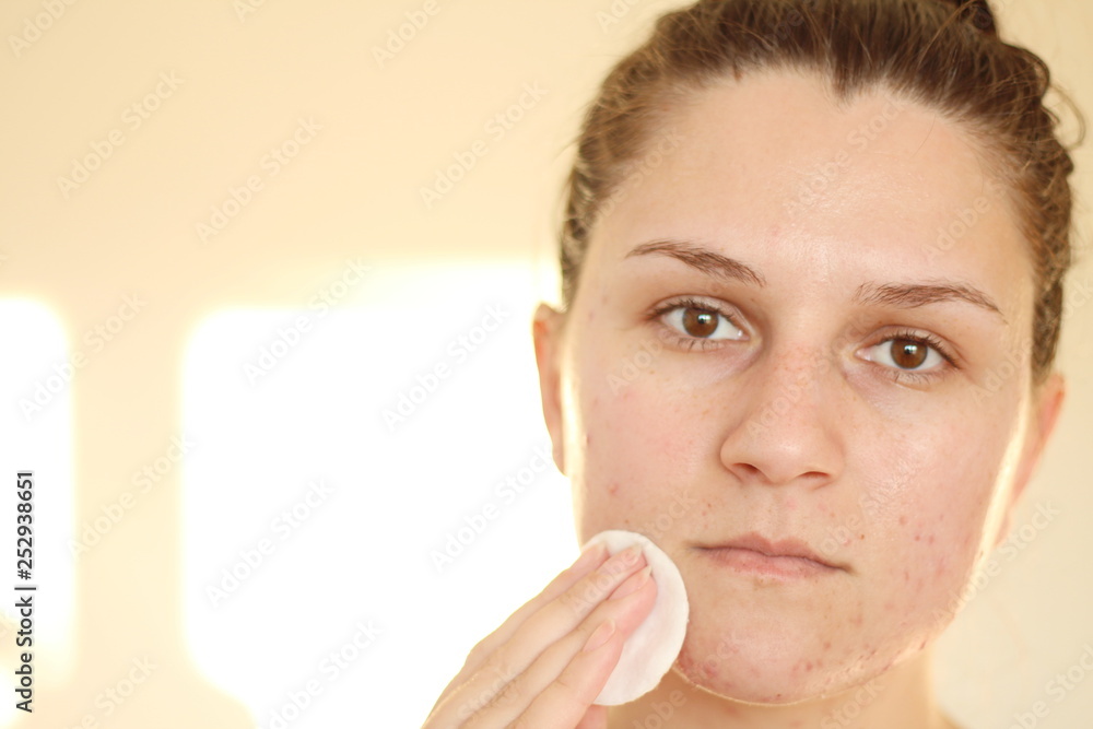 Acne on the face of young women. Improper therapy has led to a severe ...