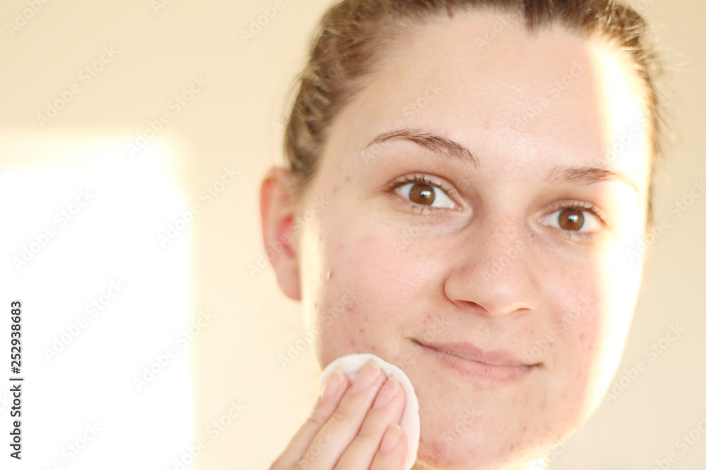 Acne on the face of young women. Improper therapy has led to a severe ...