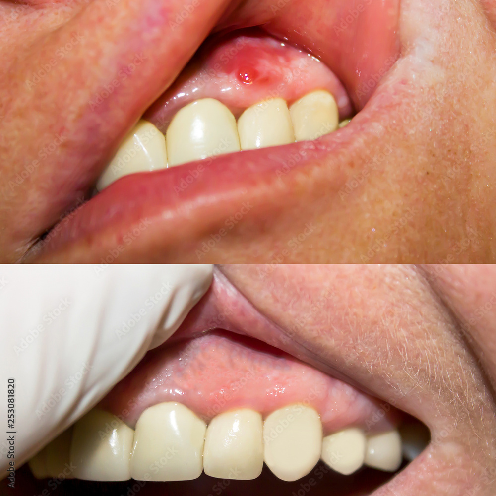 Periodontitis. Inflammatory process in the gum area. The doctor ...