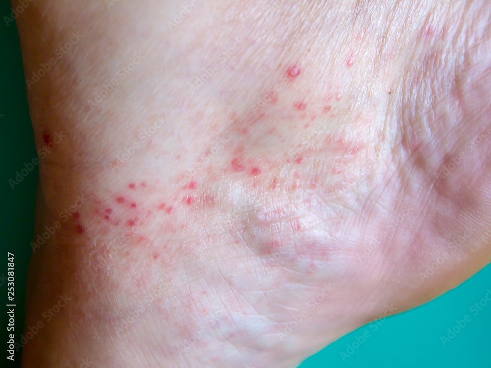 Allergic rash in the ankle joint area of the lower limb to the effect ...
