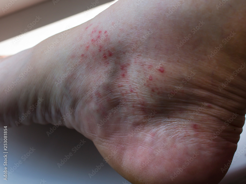 Allergic rash in the ankle joint area of the lower limb to the effect ...