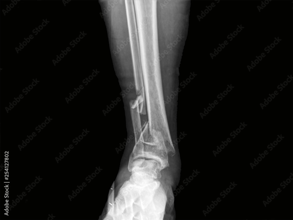 x-ray of a fracture human bone Stock Photo | Adobe Stock