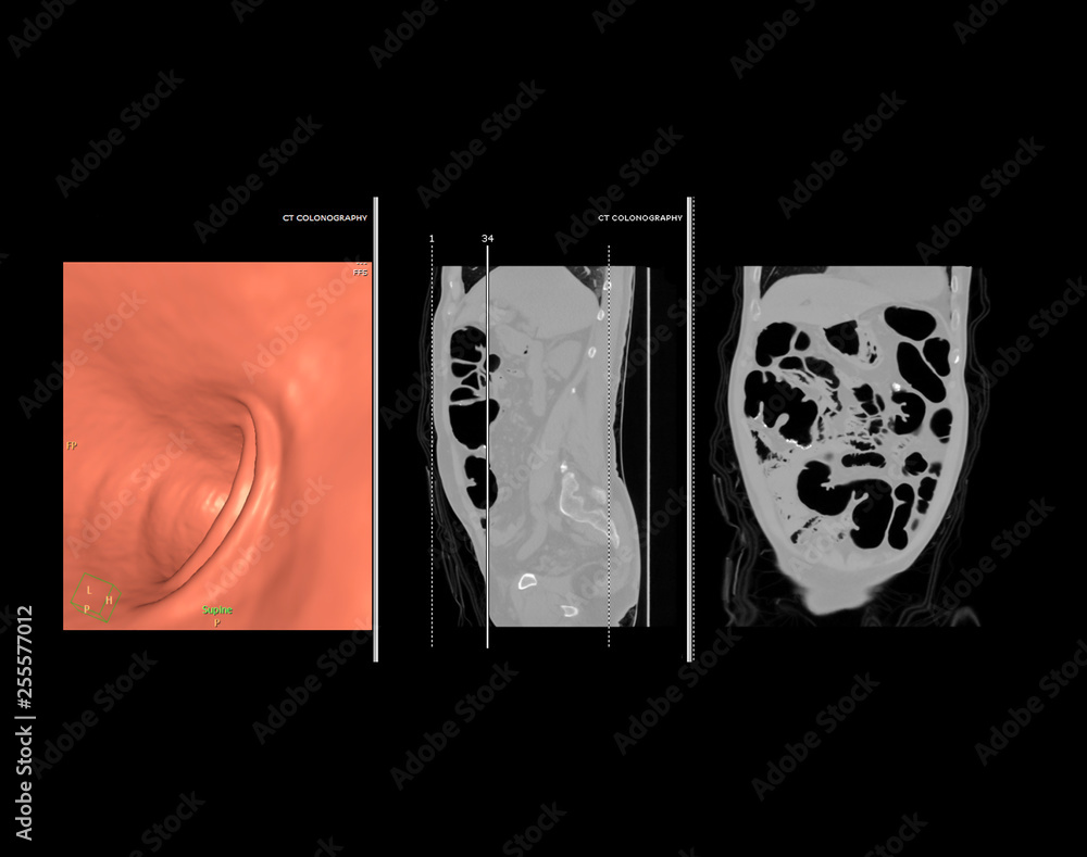 CT colonography or CT Scan of Colon 3D rendering image comparison with ...