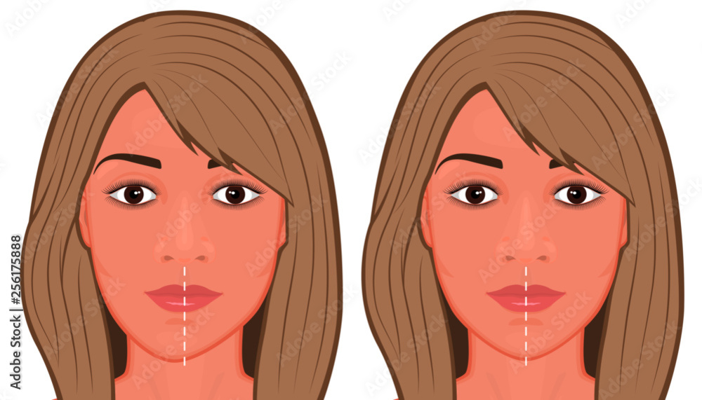 Vector illustration of a Jaw asymmetry correctiom surgery. For ...