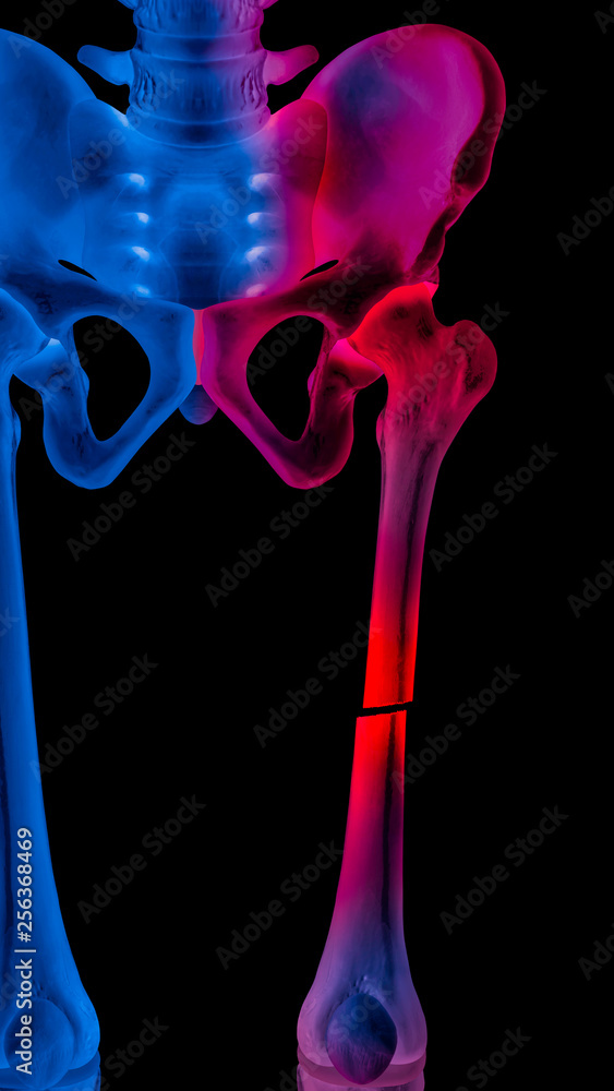 Stock-Illustration „X-ray of broken upper leg or femur fracture ...