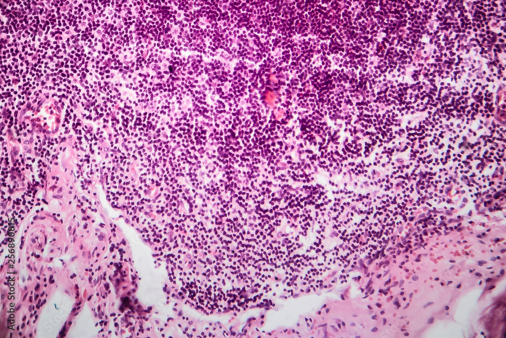 Acute simple appendicitis, light micrograph, photo under microscope ...