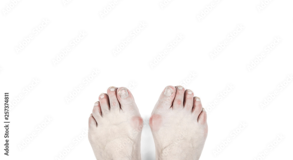 Medical condition called bunions(Hallux abducto valgus, hallux valgus ...