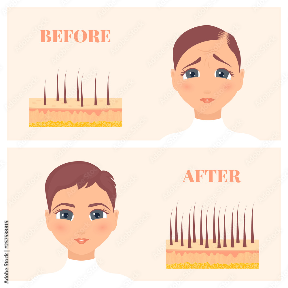 Woman suffering hair loss before and after restoration. Female pattern ...