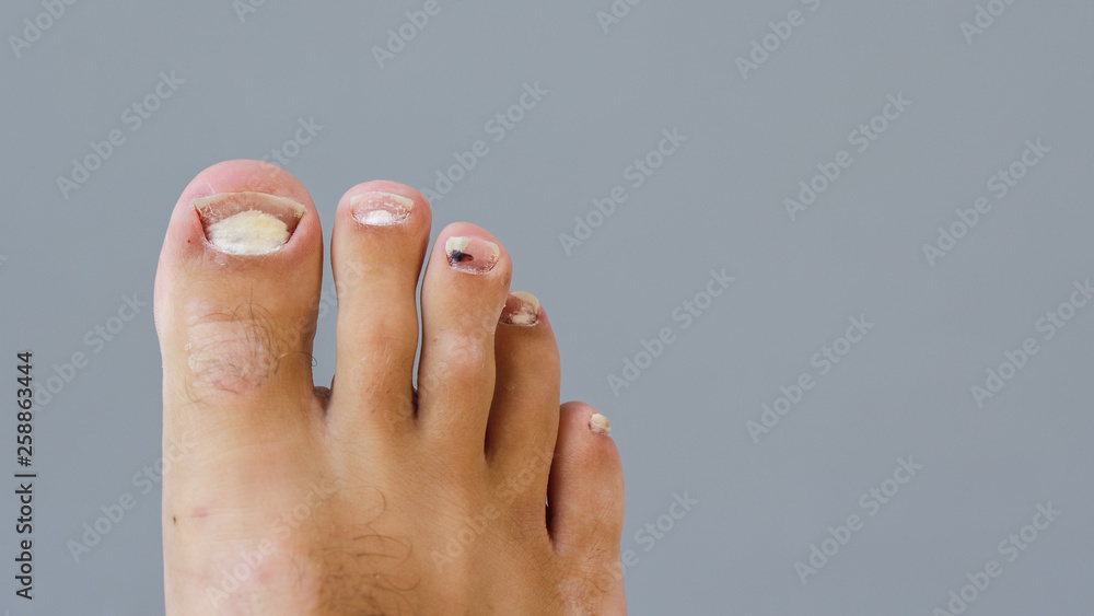 Single Right Male Foot with a Fungal Infection in the Toe Nails which ...