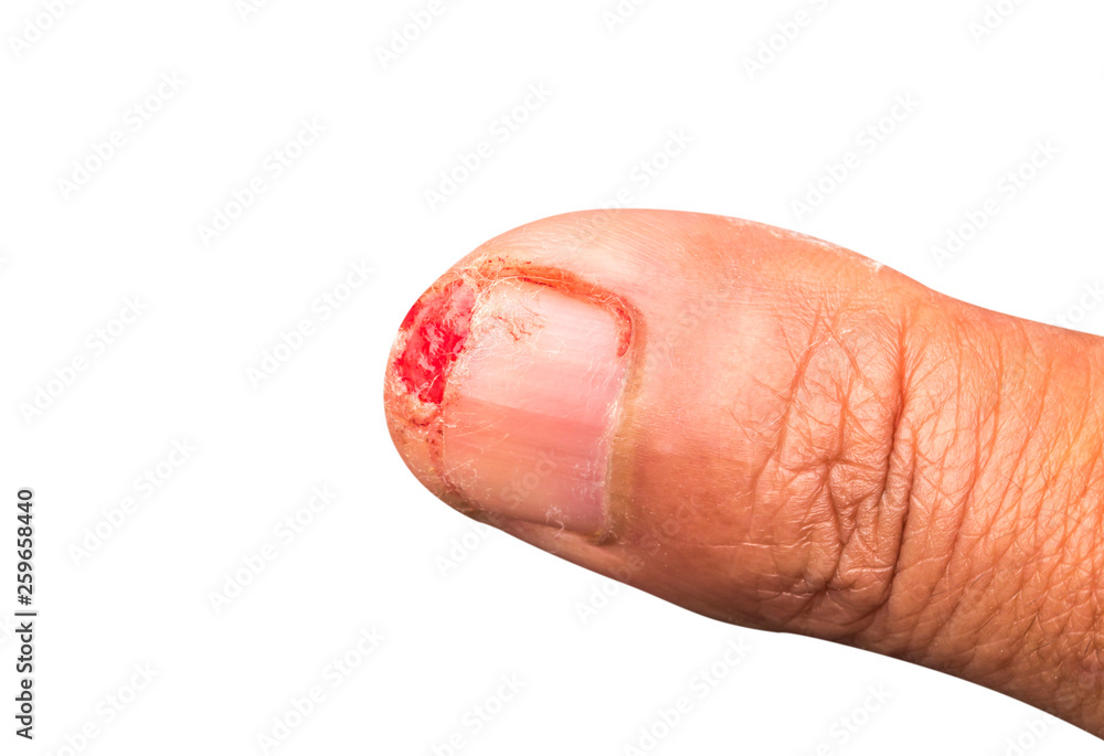 Deep wound on the fingers. Stock Photo | Adobe Stock